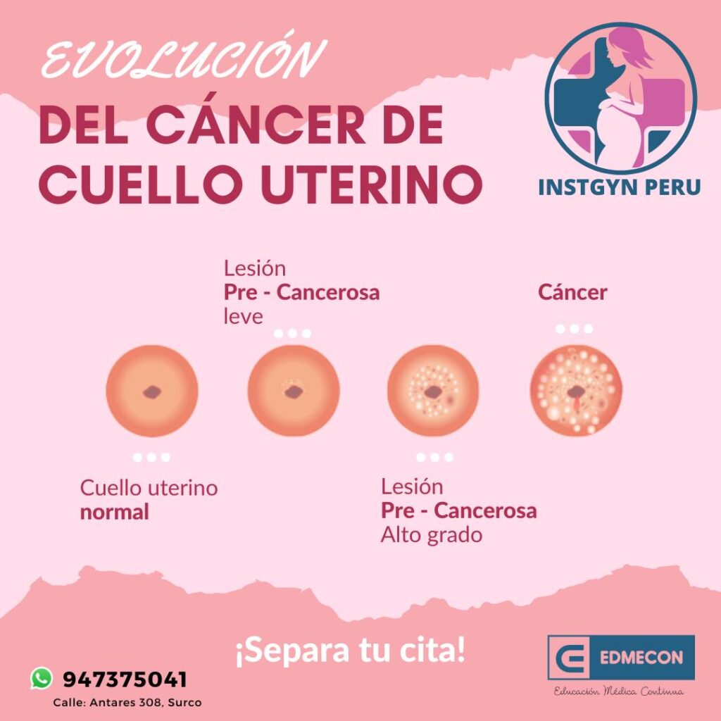 evolucion del cancer de cuello uterino - INSTGYN